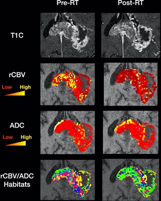 Frontiers | Visualising spatial heterogeneity in glioblastoma using imaging habitats